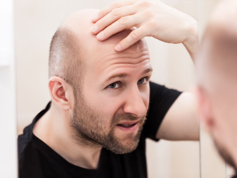 Can bald people get lice? - Lice Busters USA